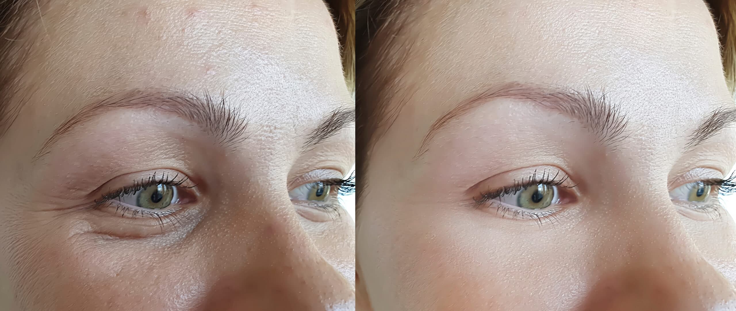 Filler Injections: Do’s and Don’ts | Scottsdale Facial Aesthetics Center
