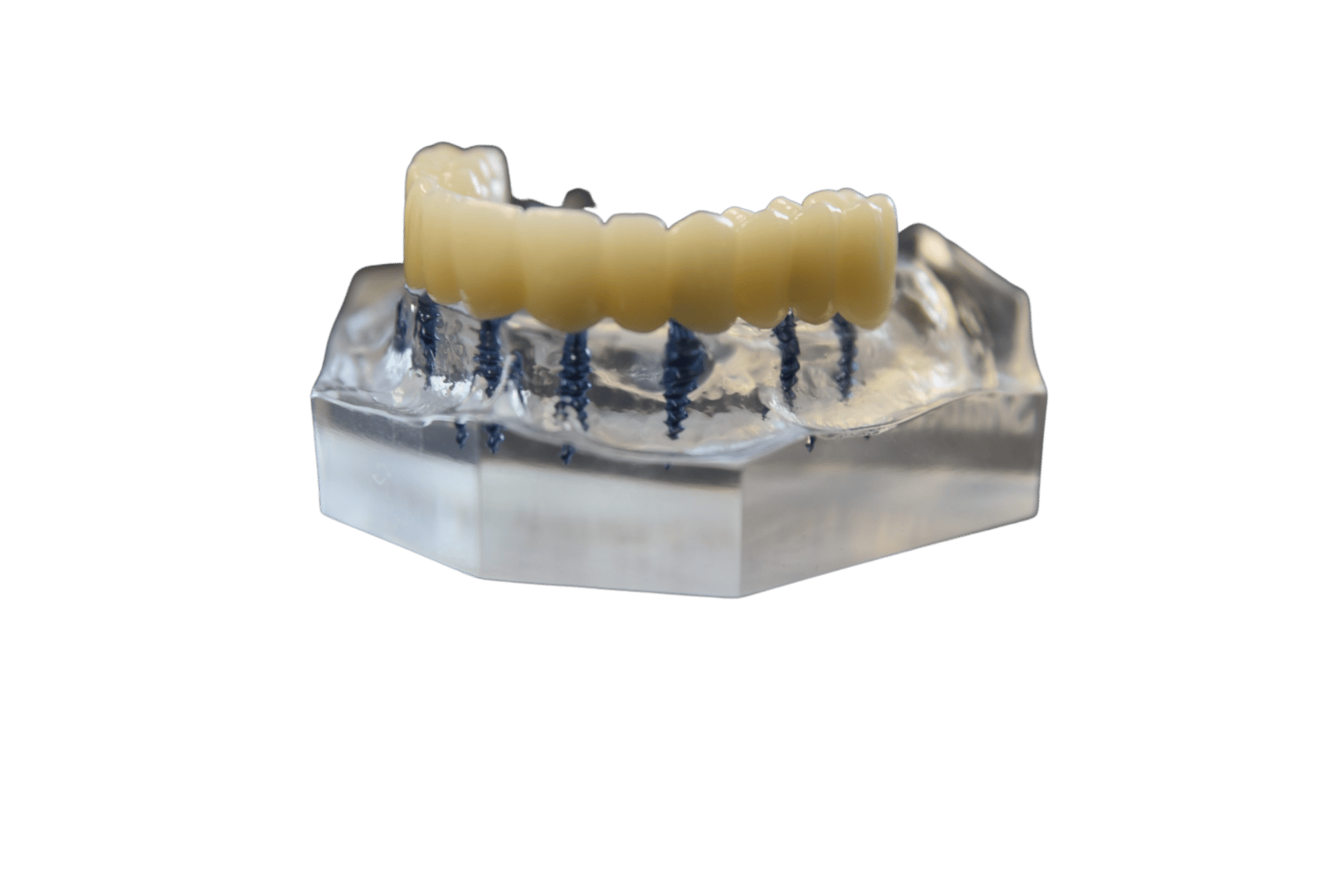 Permanent Dentures in Scottsdale, AZ | Implant Retained Dentures
